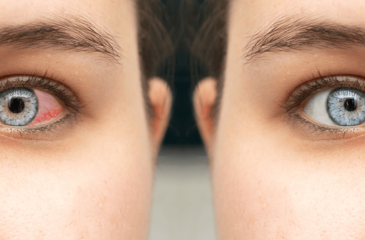 Blepharitis vs. Pink Eye: What's the Difference?